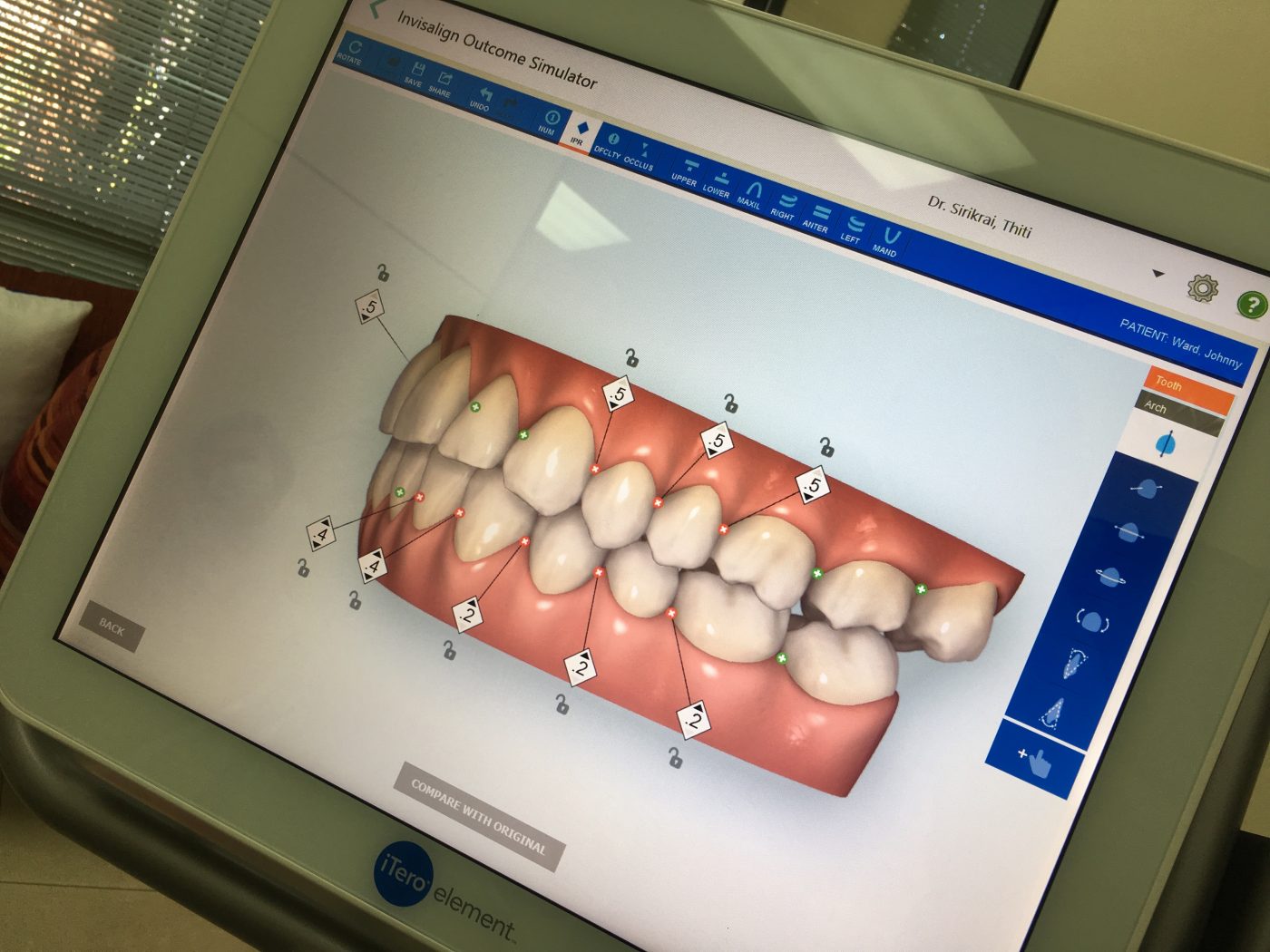 Invisalign in Bangkok - 1 Year Later